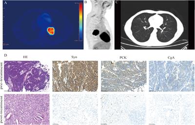 Frontiers | Pathological complete response to neoadjuvant tislelizumab ...
