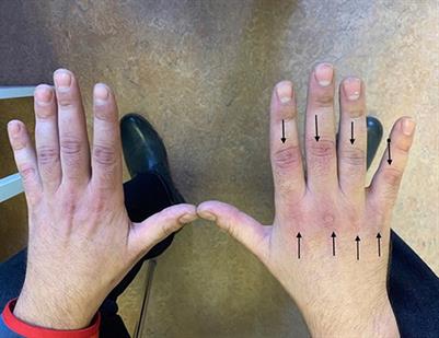 Frontiers | Case report: Unusual patient with dermatomyositis ...