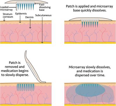 Frontiers | Microarray patch for HIV prevention and as a multipurpose ...