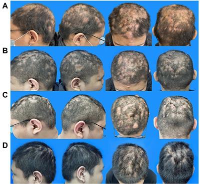Frontiers | Perifolliculitis capitis abscedens et suffodiens treatment ...