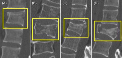 Frontiers | Automated detection and classification of acute vertebral ...