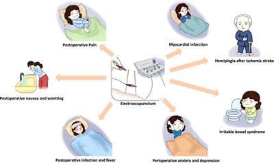 Frontiers | Clinical application of electroacupuncture in enhanced ...