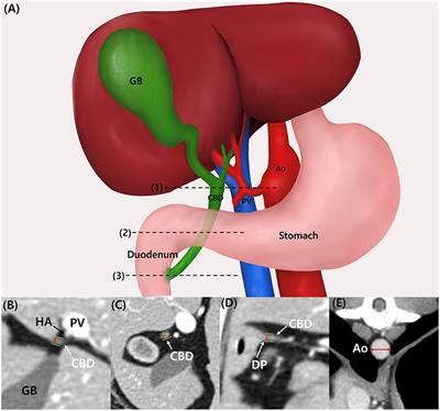 Frontiers | Computed tomographic quantitative evaluation of common bile ...