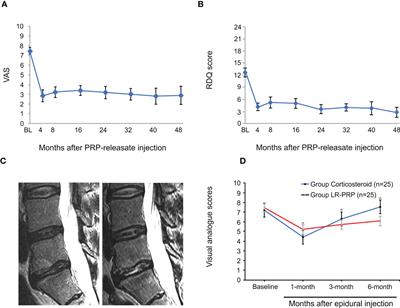 Frontiers | Application of platelet-rich plasma in spinal surgery