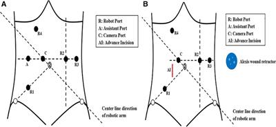 Frontiers | Application of the advance incision in robotic-assisted ...