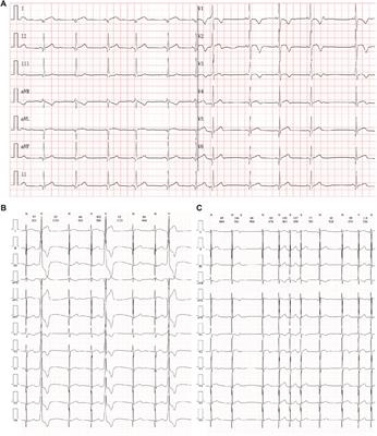 Frontiers | Misdiagnosed myocarditis in arrhythmogenic cardiomyopathy ...
