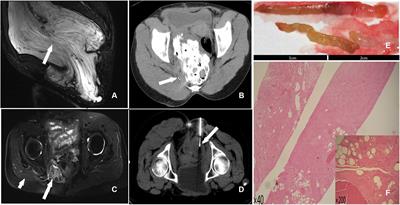 Frontiers | Aggressive angiomyxoma of the pelvis and abdominal wall ...