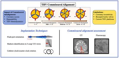 Frontiers | Transcatheter heart valve commissural alignment: an updated ...