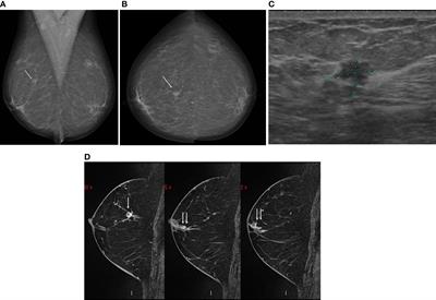 Frontiers | Prospective study: Impact of breast magnetic resonance ...