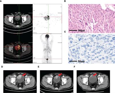 Frontiers | Case Report: PD-L1-negative advanced bladder cancer ...