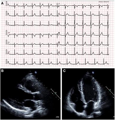 Frontiers | A CT-FFR-guided unroofing procedure for repairing the ...