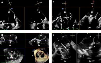Frontiers | 3-dimensional intracardiac echocardiography for structural ...