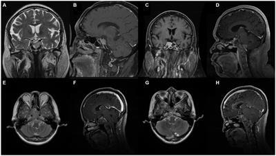Frontiers | Case report: Identification of potential prognosis-related ...