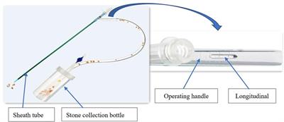 Frontiers | Comparative efficacy between retrograde intrarenal surgery ...
