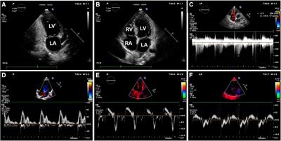 Frontiers | Comparison of two echocardiography-based methods for ...