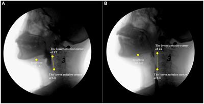 Frontiers | Findings of a videofluoroscopic swallowing study in ...
