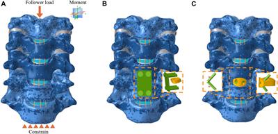 Frontiers | Biomechanical evaluation of a novel individualized zero ...