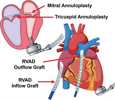 Frontiers | Case report: Facilitating right heart recovery after ...