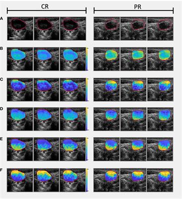 Frontiers | Predicting head and neck cancer treatment outcomes with pre ...