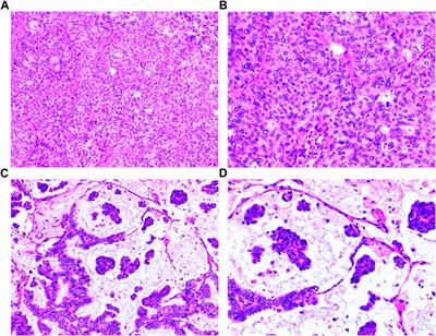 Frontiers | Case report: Clinical management of recurrent small cell ...