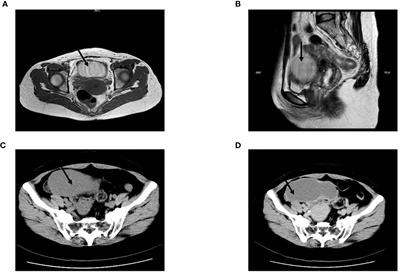Frontiers | Repeated misdiagnosis of small intestine bronchogenic cyst ...