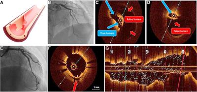 Frontiers | Invasive imaging modalities in a spontaneous coronary ...