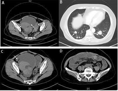 Frontiers | Case report: Rupture of an ileus tube in a patient with ...