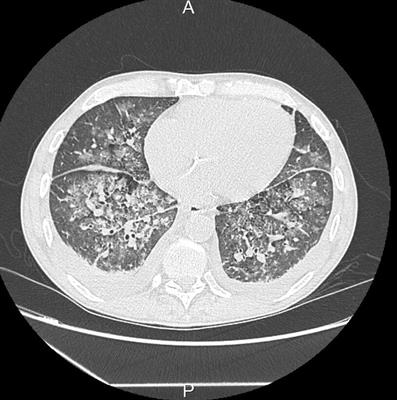 Frontiers | Rare manifestations of cryoglobulinemic vasculitis: a case ...