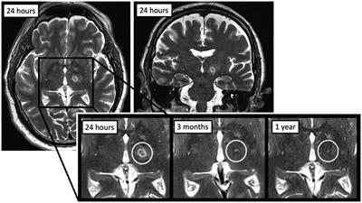 Frontiers | Longitudinal MR imaging after unilateral MR-guided focused ...