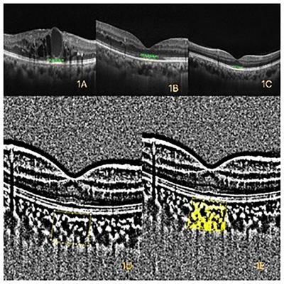 Frontiers | Quantitative assessment of OCT and OCTA parameters in ...
