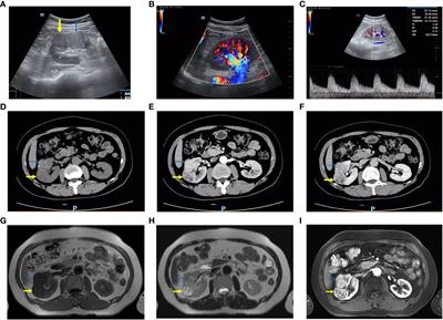 Frontiers | Case report: A collision tumor of clear cell renal cell ...