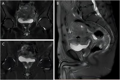 Frontiers | Positive outcomes with neoadjuvant chemotherapy in the ...