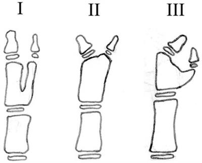 Frontiers | Radiographic features of congenital thumb duplication type ...