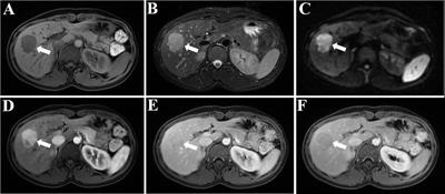 Frontiers | Hepatic perivascular epithelioid cell tumor resembling ...