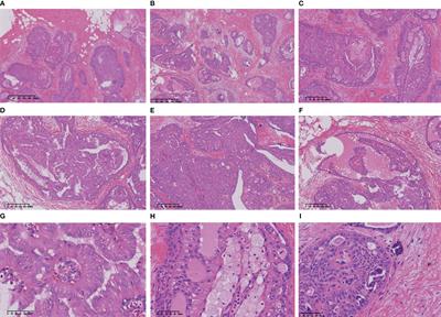 Frontiers | Case report: Tall cell carcinoma with reversed polarity of ...