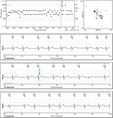 Frontiers | Implantable cardiac monitors: artificial intelligence and ...