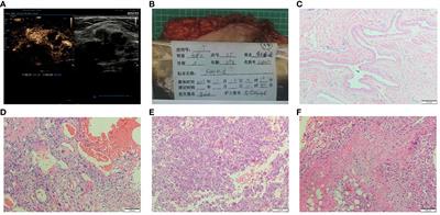 Frontiers | Malignant phyllodes tumor of the breast with predominant ...