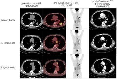 Frontiers | Case report: Pathological complete response induced by ...