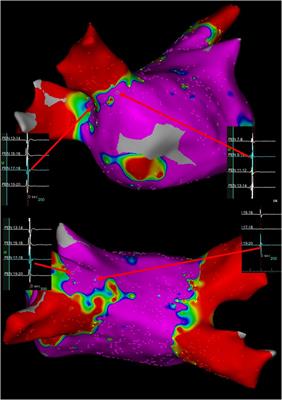 Frontiers | Radiofrequency catheter ablation for re-do procedure after ...
