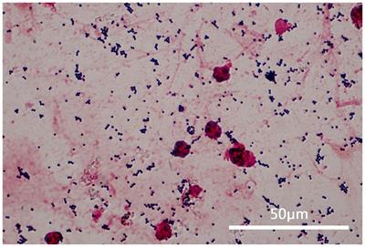 Frontiers | Case report: Methicillin-resistant Staphylococcus aureus ...