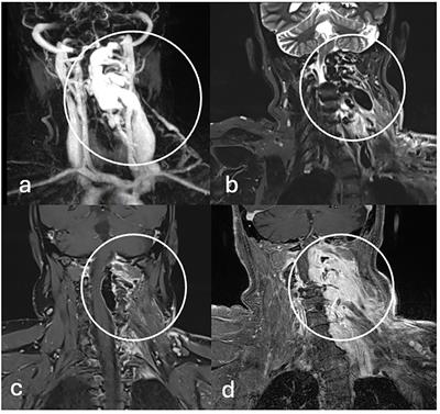 Frontiers | Case report: Atypical neurofibromatous neoplasm with ...