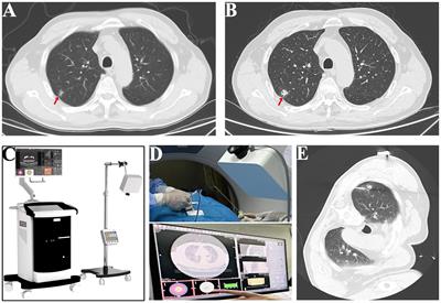 Frontiers | Computed tomography guided electromagnetic navigation ...