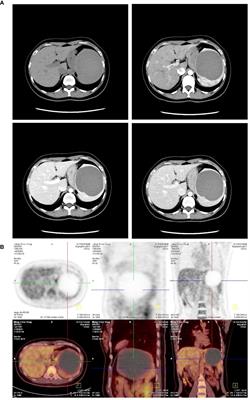 Frontiers | Abrupt elevation of tumor marker levels in a huge splenic ...