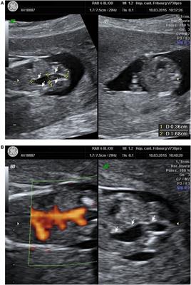Frontiers | 22q11 Deletion Syndrome and Urogenital Manifestations: A ...