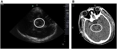 Frontiers | Comparison between Brain Computed Tomography Scan and ...