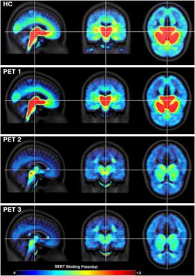How Serotonin Works In The Brain