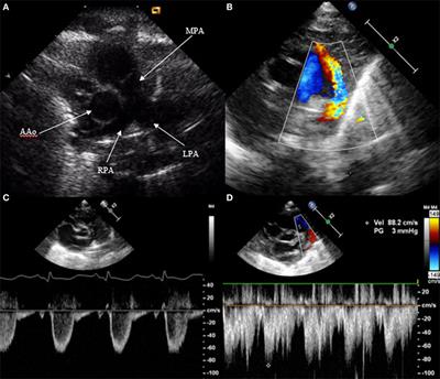 Frontiers | Echocardiographic Evaluation of Patent Ductus Arteriosus in ...