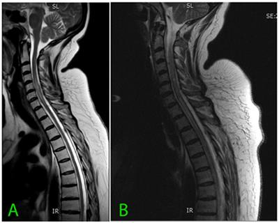 Abnormal Cervical Spine Mri