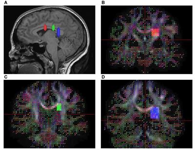 Frontiers | The Superior Fronto-Occipital Fasciculus in the Human Brain ...
