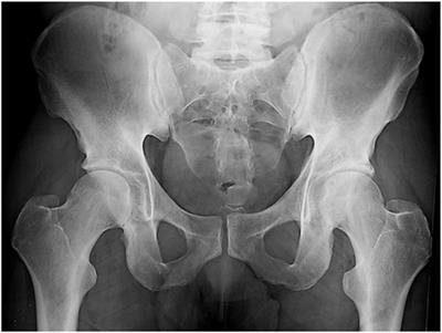 Sacroiliac Joint Xray